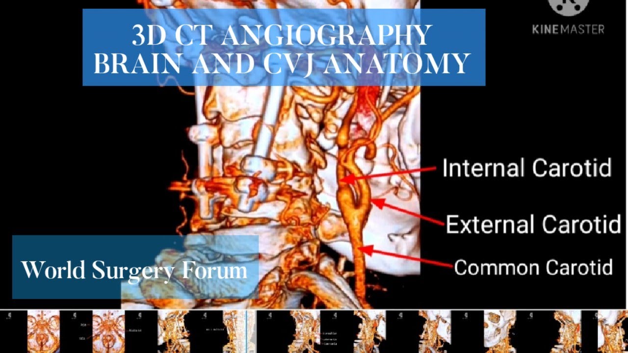 3D CT ANGIOGRAPHY - BRAIN & CVJ Vascular Anatomy | Dr Sandeep ...