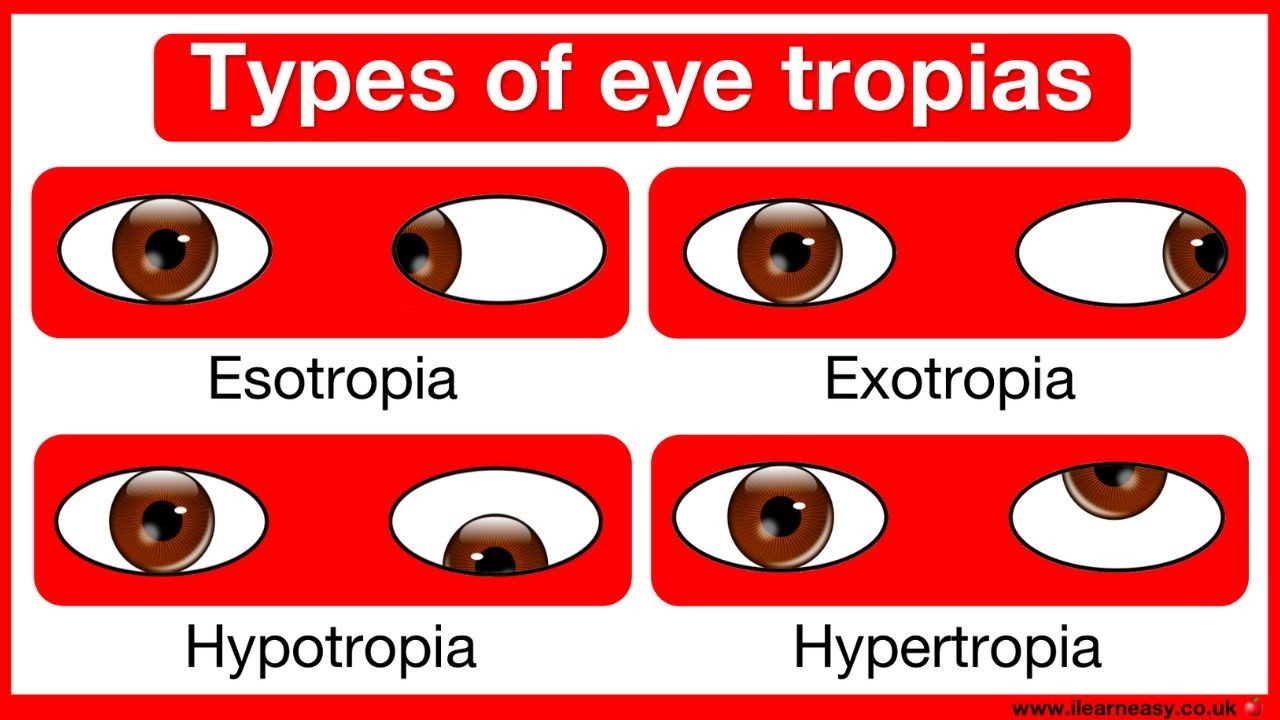 Types of tropias 👁️ | Esotropia, exotropia, hypotropia & hypertropia ...