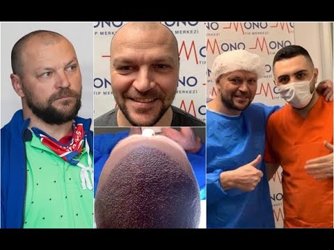Plešatý Tomáš Ujfaluši je minulostí. Nechal si v Turecku nastřelit vlasy, lékaři ho s tím uháněli