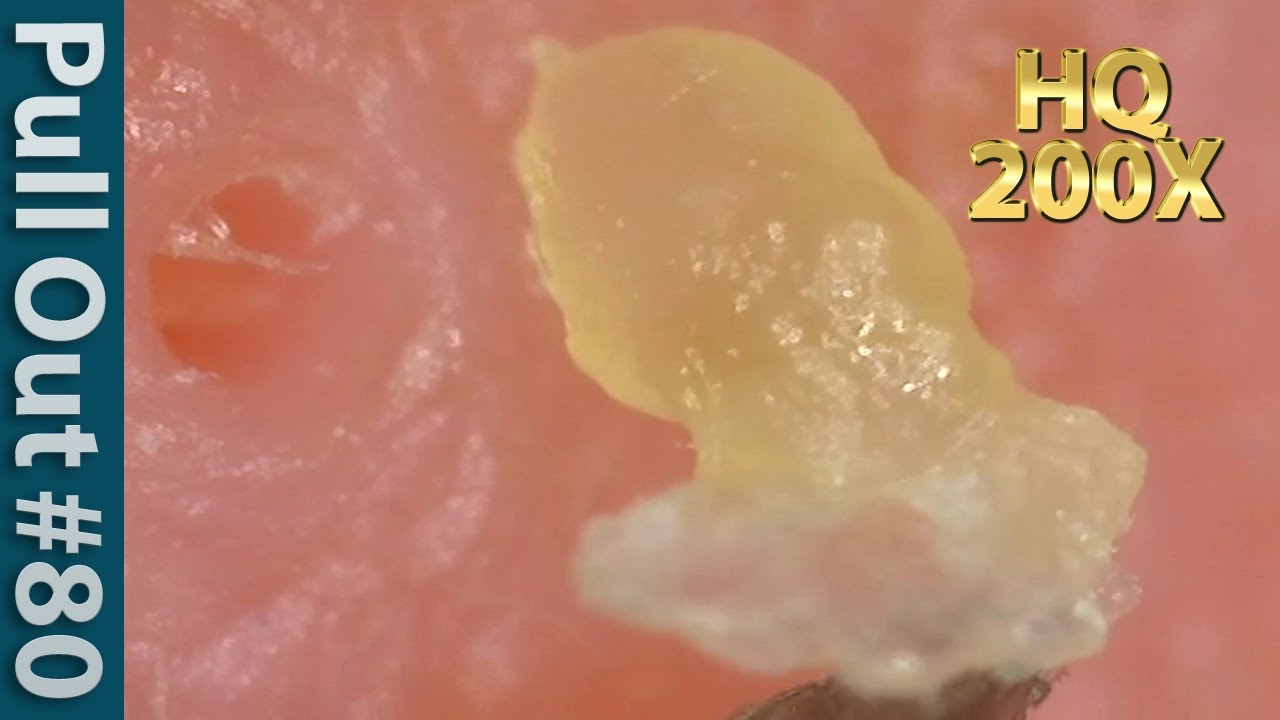 #80 Pull Out Blackheads Close up 200X - Blackheads Removal | ピンセットで角栓を ...