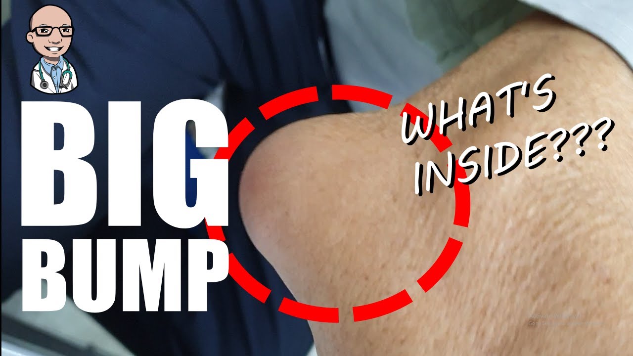 THE BIGGEST ELBOW CYST EVER ??? - YouTube