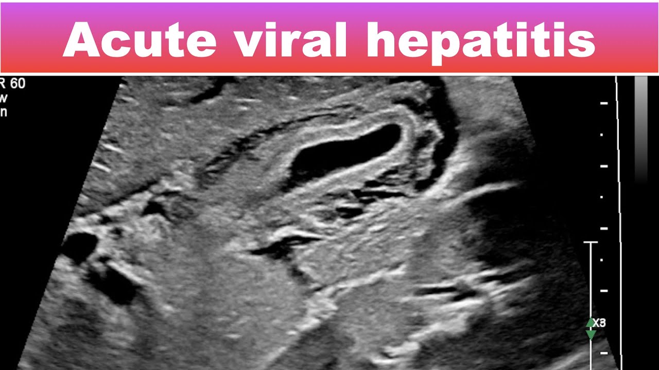 Acute viral hepatitis I Ultrasound - YouTube