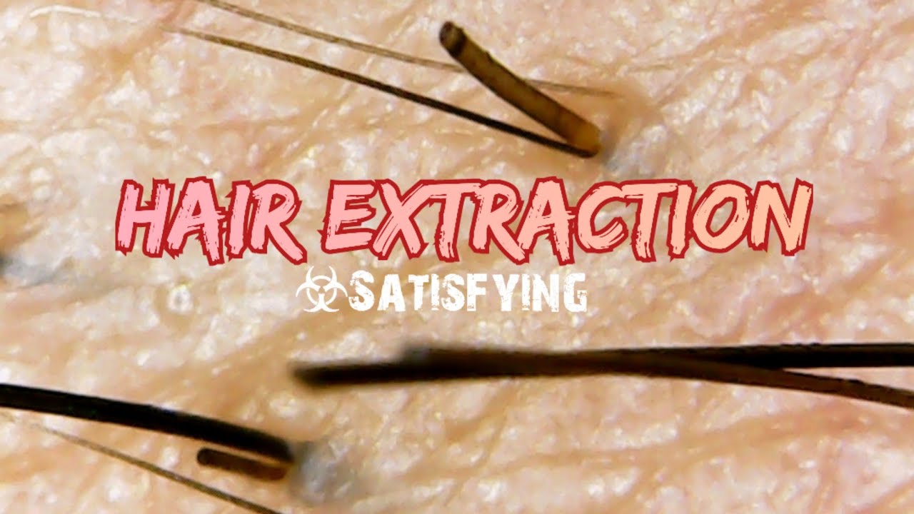 Hair Extraction*satisfying - YouTube
