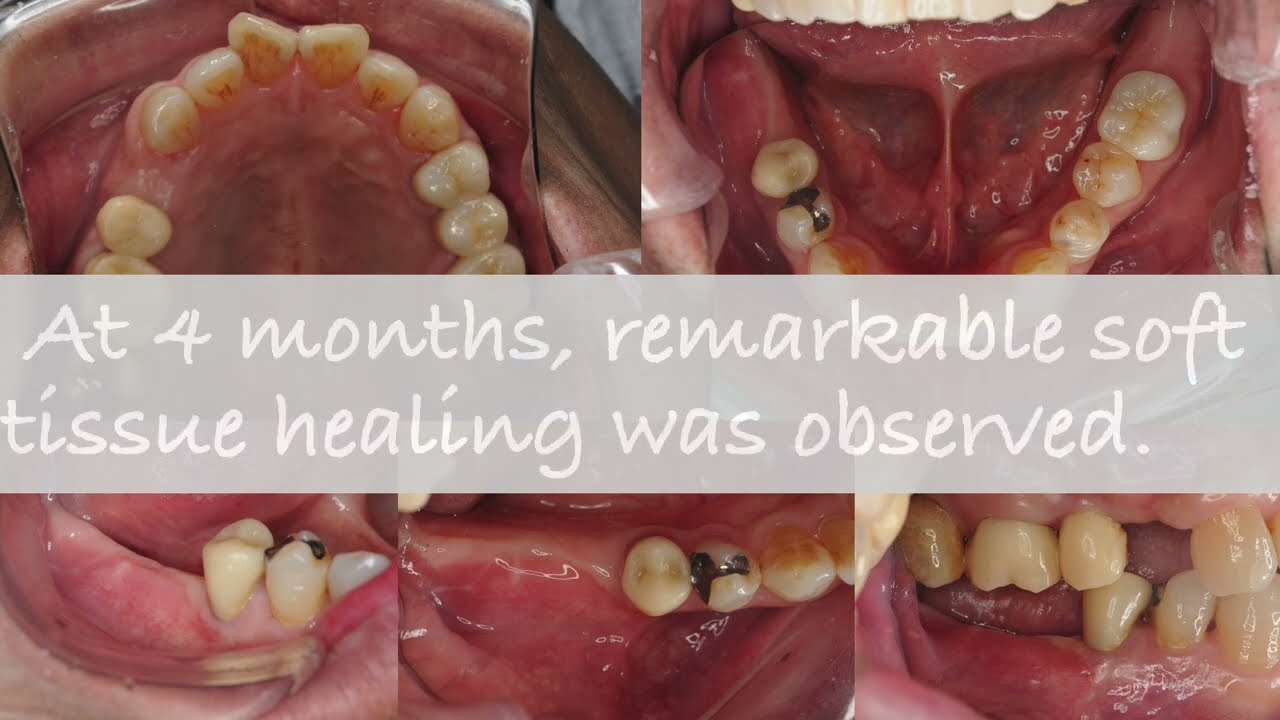 Right maxilla and mandible bone defects were augmented using the Khoury ...
