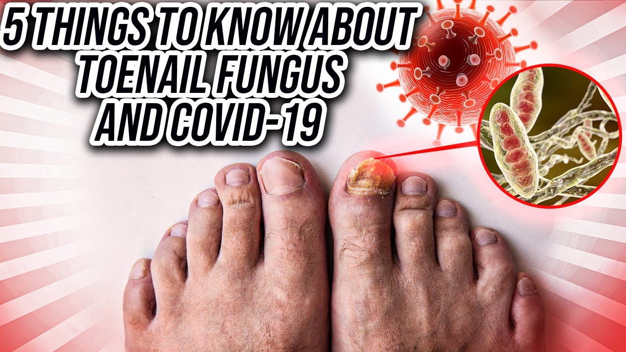 5 Things To Know About Toenail Fungus And COVID-19 - YouTube