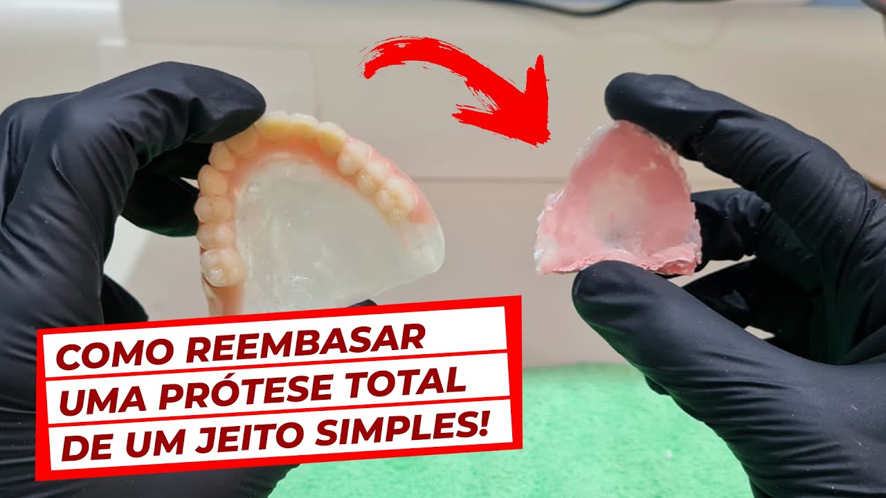 COMO REEMBASAR UMA PRÓTESE TOTAL DE UM JEITO SIMPLES! (Prótese Dentária ...