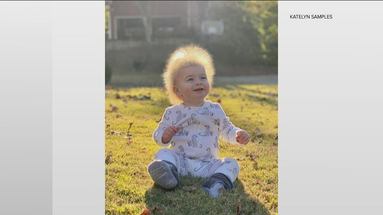 Atlanta toddler's fuzzy hair raises awareness about rare genetic ...