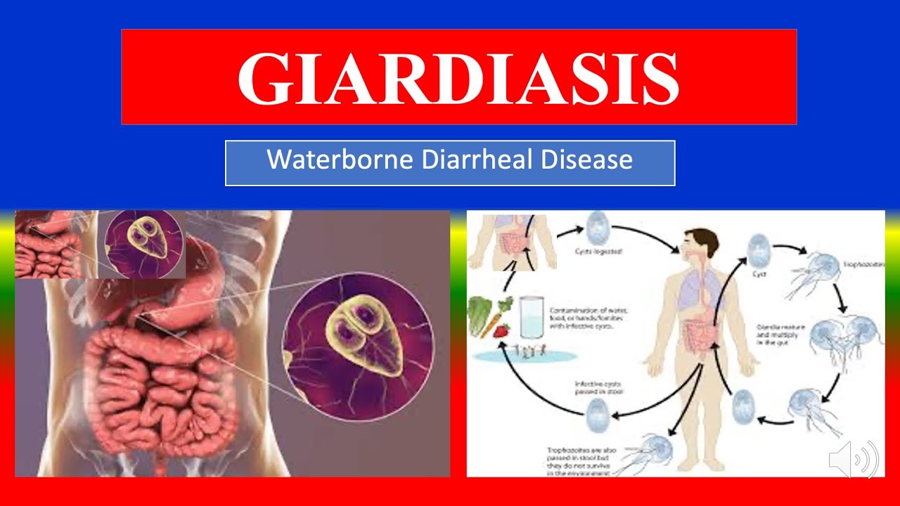 GIARDIASIS - Definition, types, causes, pathophysiology, symptoms ...