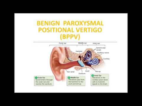Dix Hallpike maneuver for BPPV - YouTube