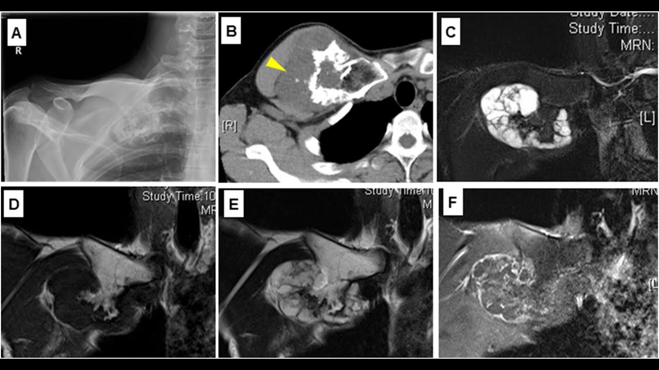 Osteochondroma of Lower Dorsal Spine in Hereditary Multiple Exostosis ...