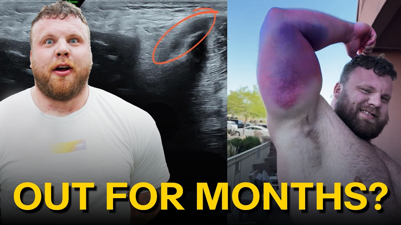 Strongest Man on Earth Tom Stoltman INJURY EXPLAINED - YouTube