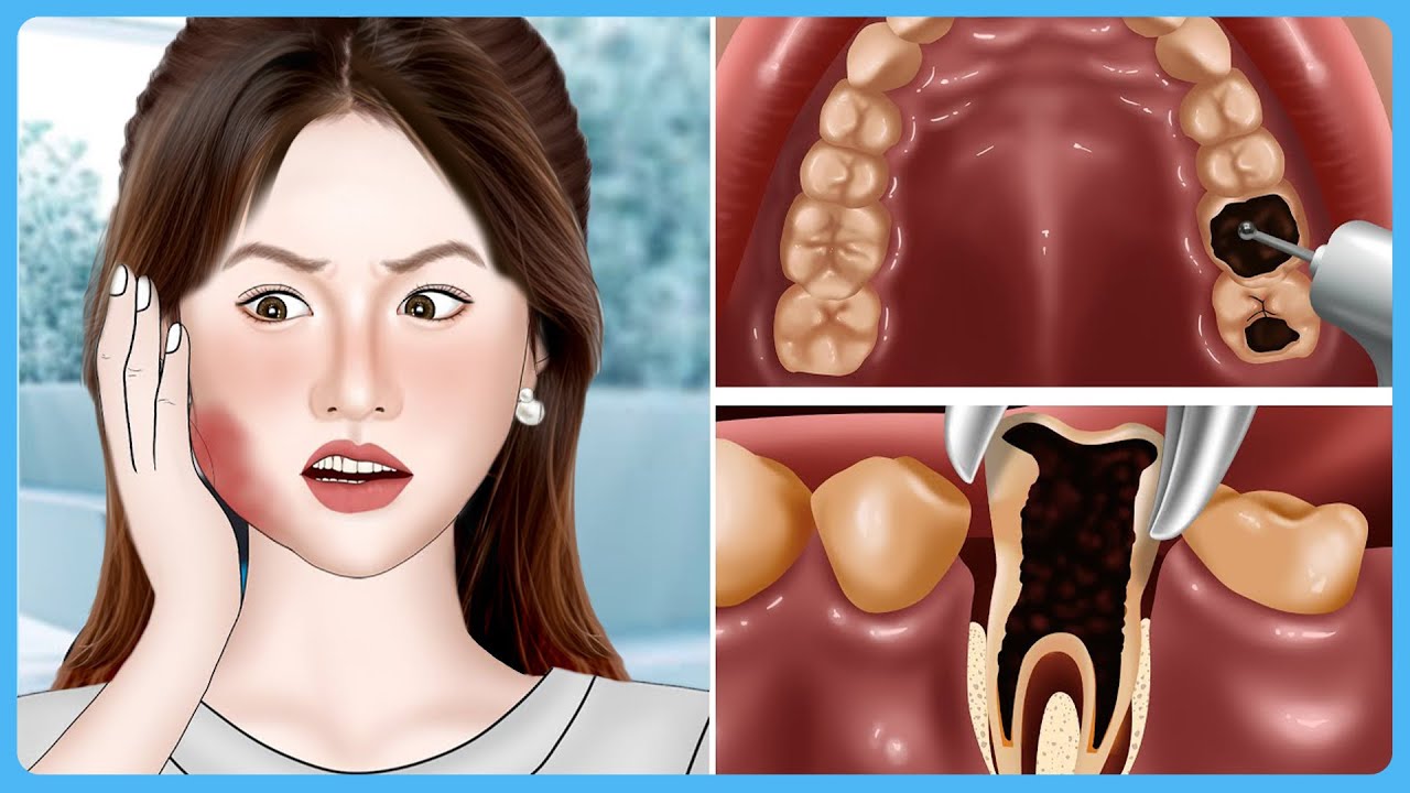 ASMR Help Relieve the Pain of Wisdom Tooth | Dental care Animation ...