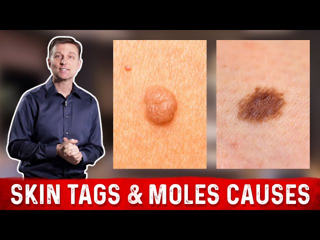 What Causes Skin Moles