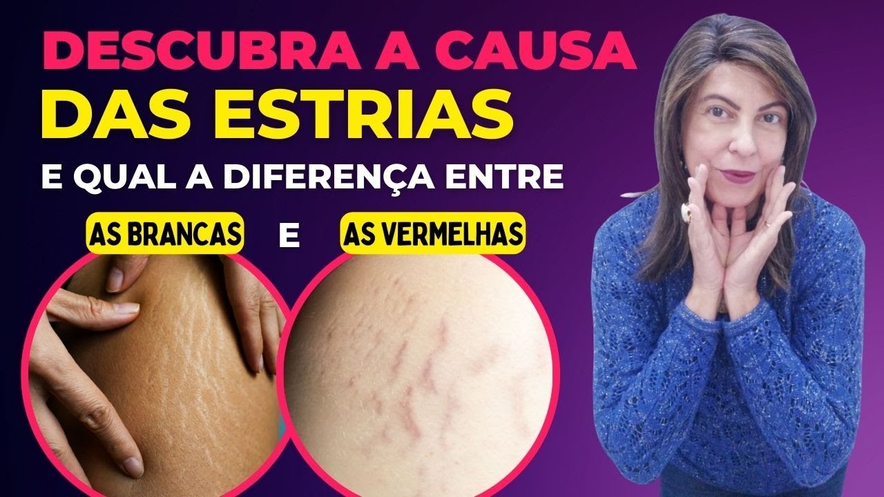 (#697) Descubra a causa das estrias e a diferença entre as brancas e as ...