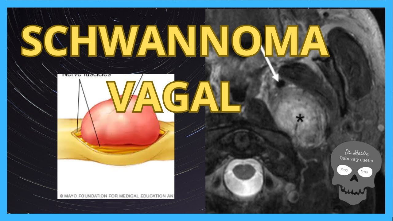 SCHWANNOMA VAGAL👉Hallazgos Radiológicos - YouTube