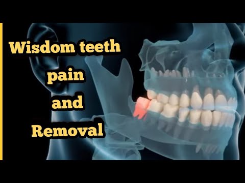 Wisdom tooth extraction -Animation #doctor #amu #medicalstudent # ...