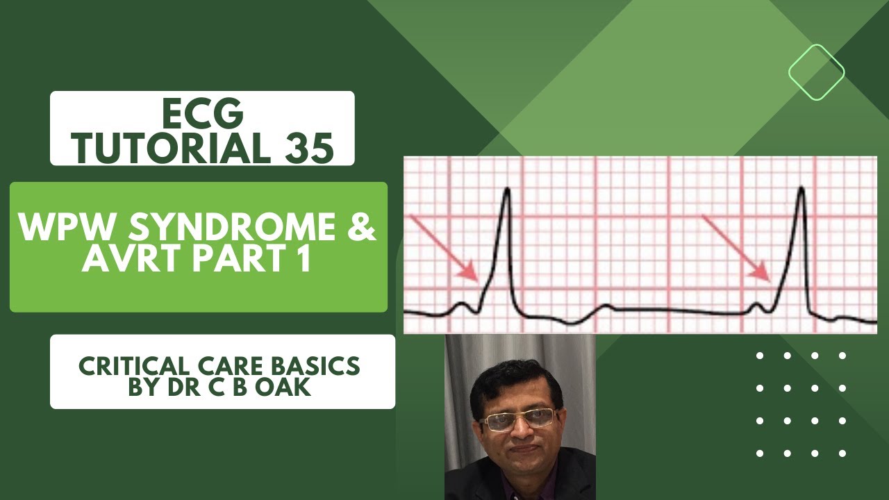 ECG Tutorial 35 WPW syndrome & AVRT Part 1 - YouTube