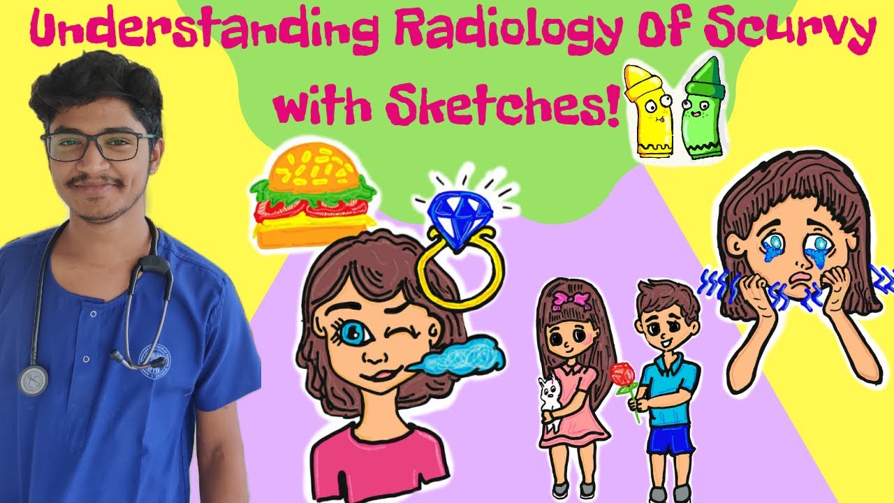 RADIOLOGICAL FEATURES OF SCURVY IN 2 MIN | NEETPG | MNEMONICS ...