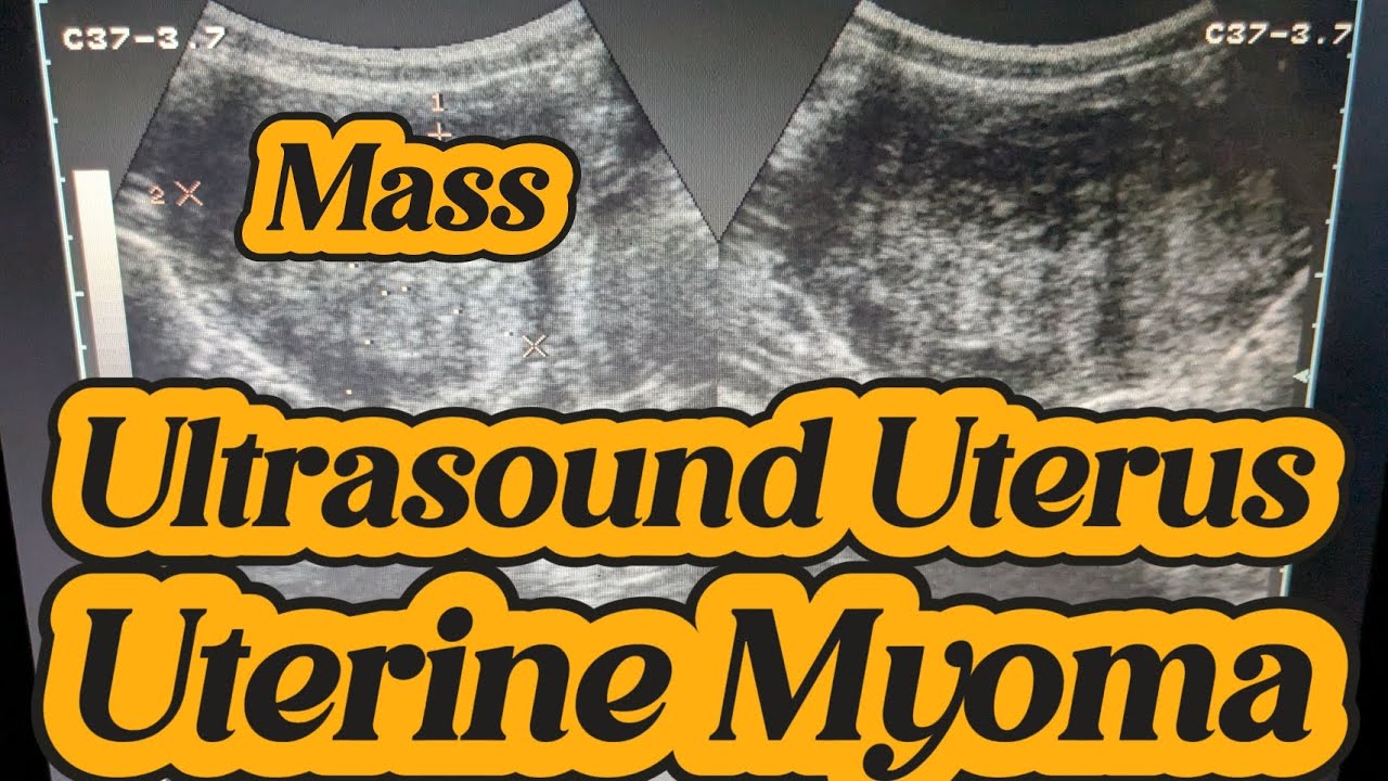 How to Ultrasound Uterus Fibroid | Ultrasound Uterus Mass | Uterine ...
