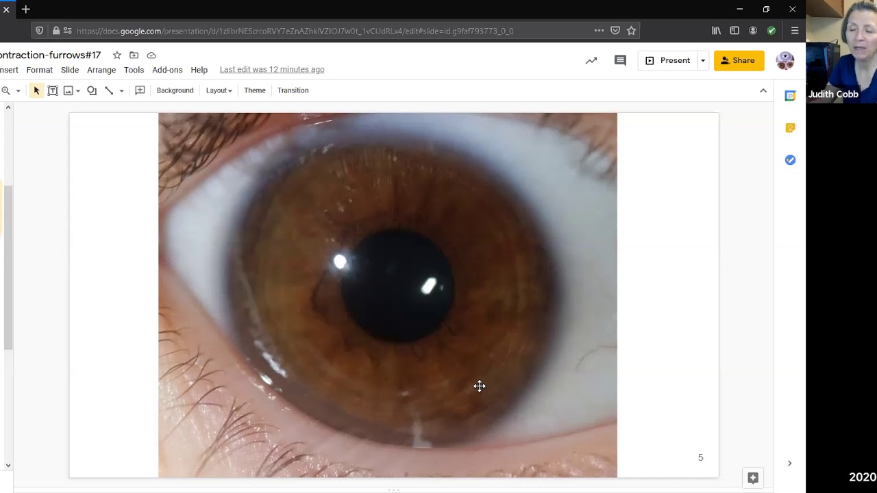 Are they Nerve rings or Contraction Furrows? - YouTube