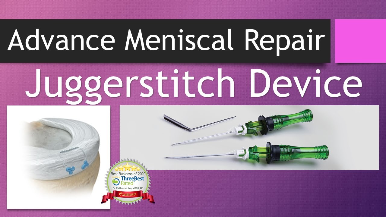 Most Advanced Meniscal Repair JUGGERSTITCH Device : English (All Inside ...