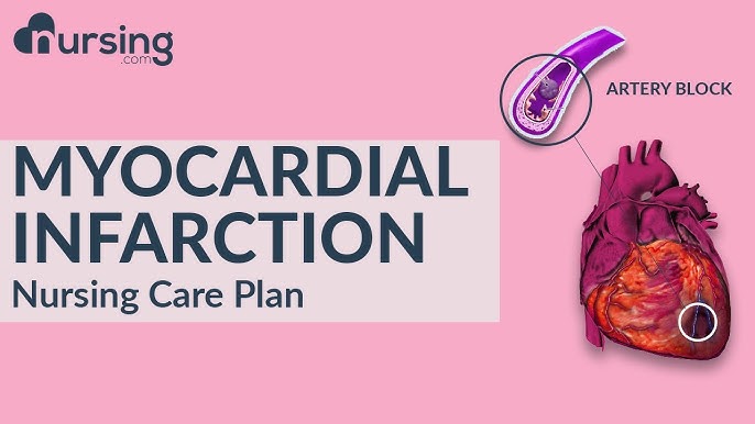 Myocardial Infarction Nursing Care Management And Study Guide