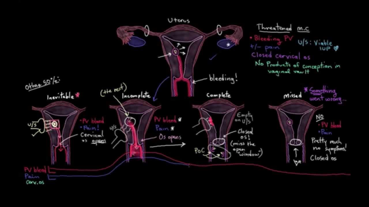 Miscarriage Basics and Types - YouTube