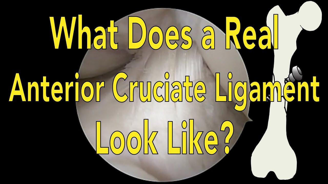 What Does a Real ACL Look Like? - YouTube