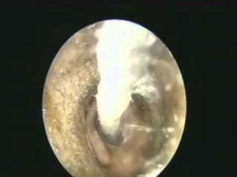 Myringitis Granulosa [Ear, Nose and Throat] - YouTube