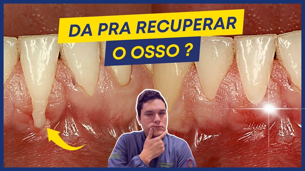Perda óssea Dentária Sintomas - RETOEDU