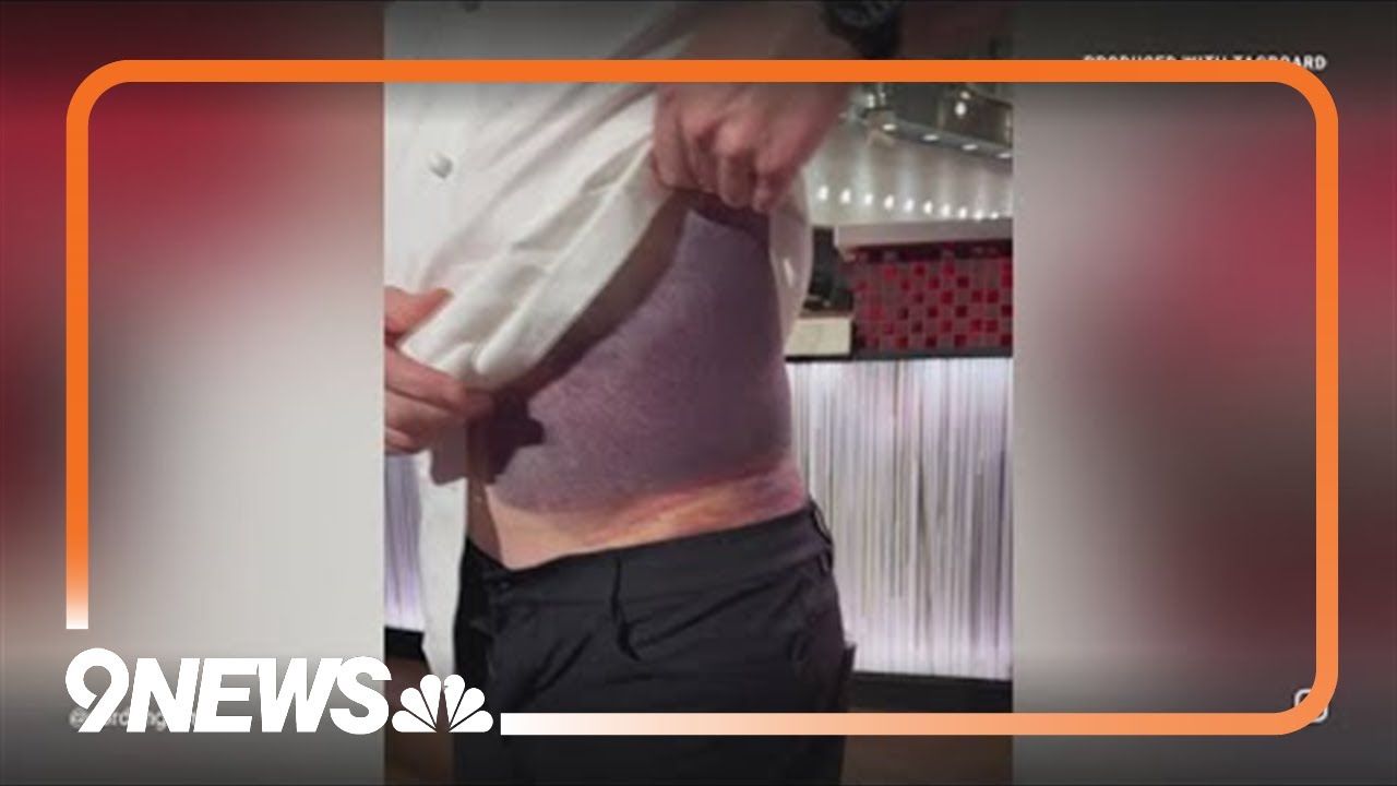 Gordon Ramsay shows massive bruise after bike accident - YouTube