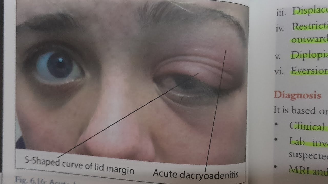 Dacryoadenitis - EYE - YouTube