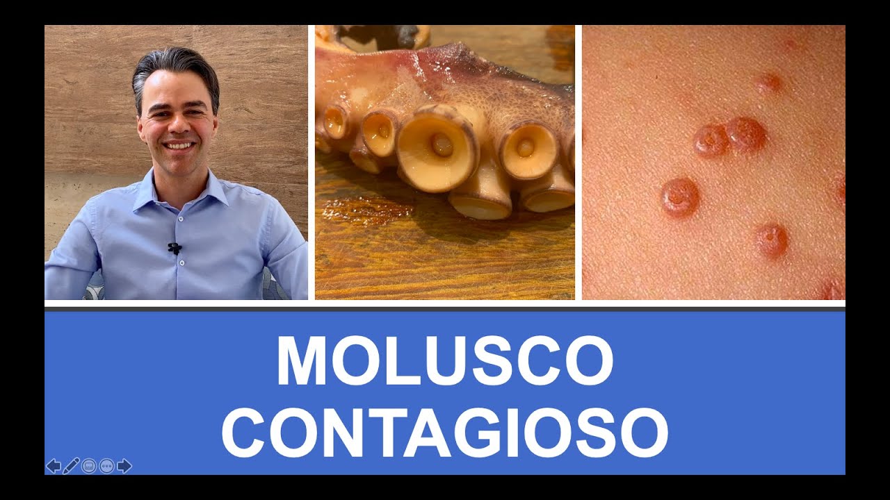 O QUE É MOLUSCO CONTAGIOSO? COMO TRATAR? - YouTube