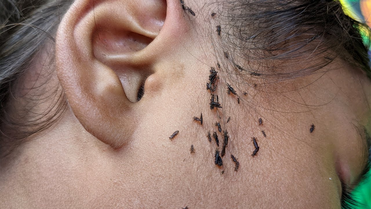 Comb all hundred lice from hair - Remove thousand lice from long hair ...