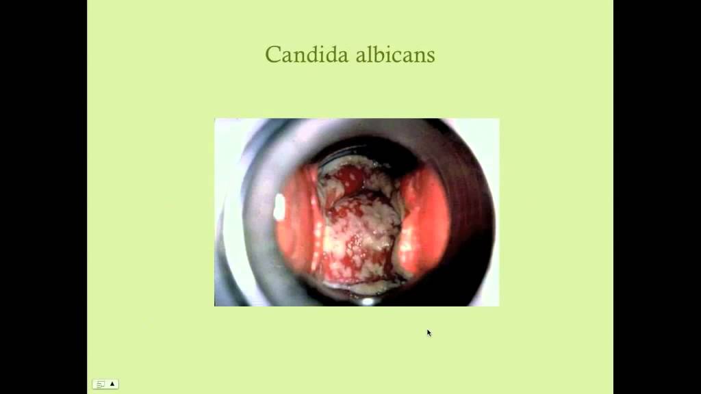Vaginitis - CRASH! Medical Review Series - YouTube