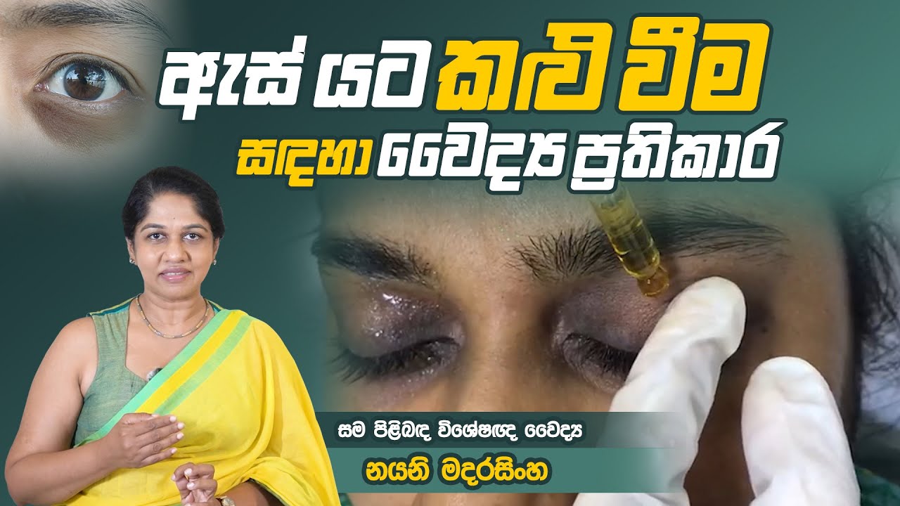 Under Eye Dark Circles Treatment Sinhala | Dr Nayani Madarasinghe - YouTube