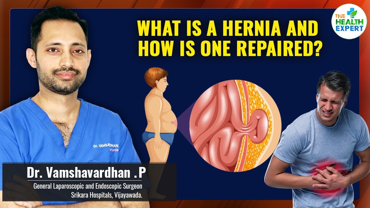What Is a Hernia and How Is One Repaired? Types Of Hernia & it Causes ...