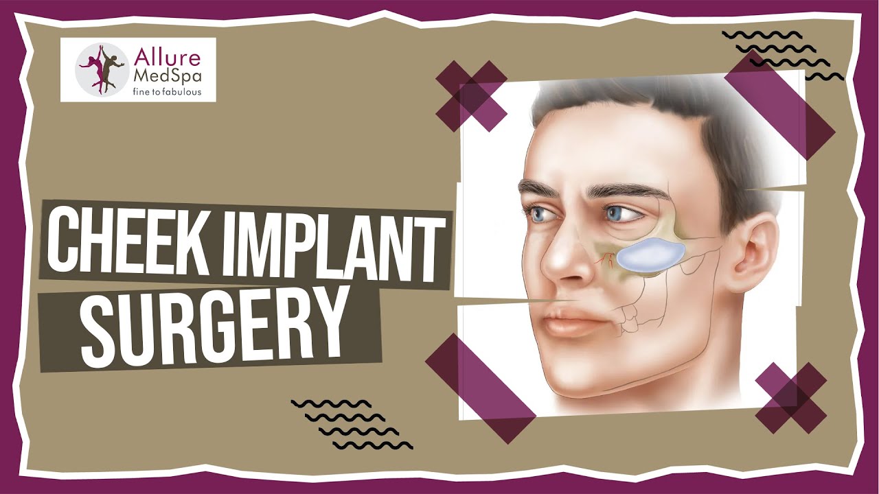 Indian Cheek Implant Surgery(Genioplasty) | Dr.Milan Doshi M.Ch, M.S ...
