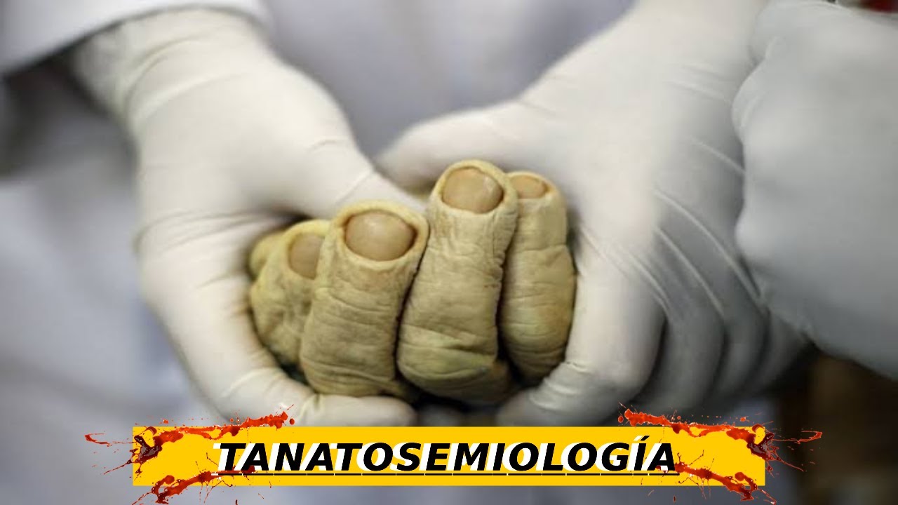 Signos Cadavéricos Tempranos | Medicina Forense - YouTube