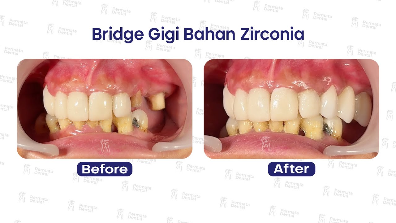 Proses Pemasangan Bridge Gigi Berbahan Zirconia di Permata Dental #4 ...