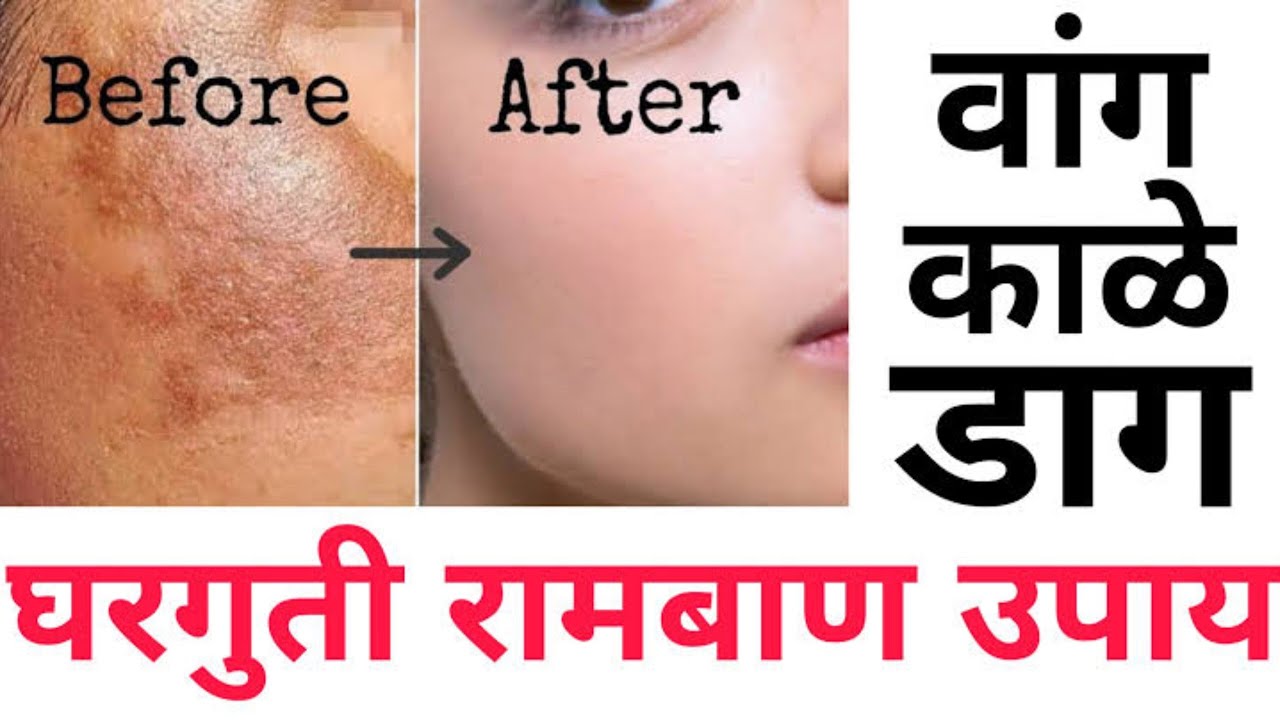 चेहऱ्यावरील वाग दूर करण्याची सोपी पद्धत| how to remove ...