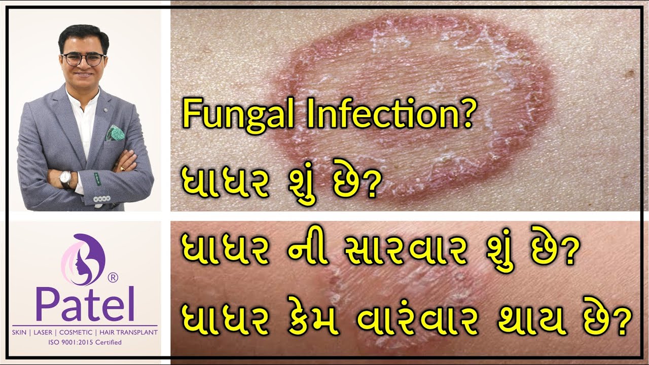 Fungal Infection Of Skin ધાધર શું છે Treatment Tips In Gujarati By Dr