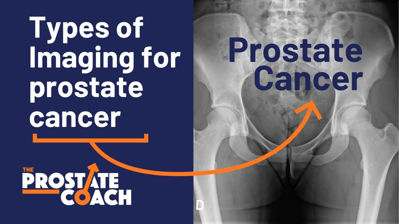 Types of Imaging to help better understand your stage of prostate ...
