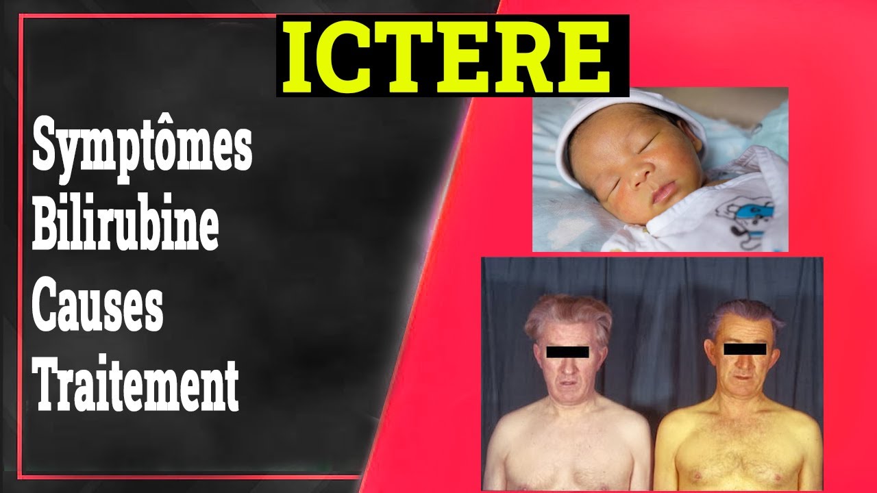 Ictère: Conduite a Tenir, Causes, Traitement | Gastrologie Medicale ...
