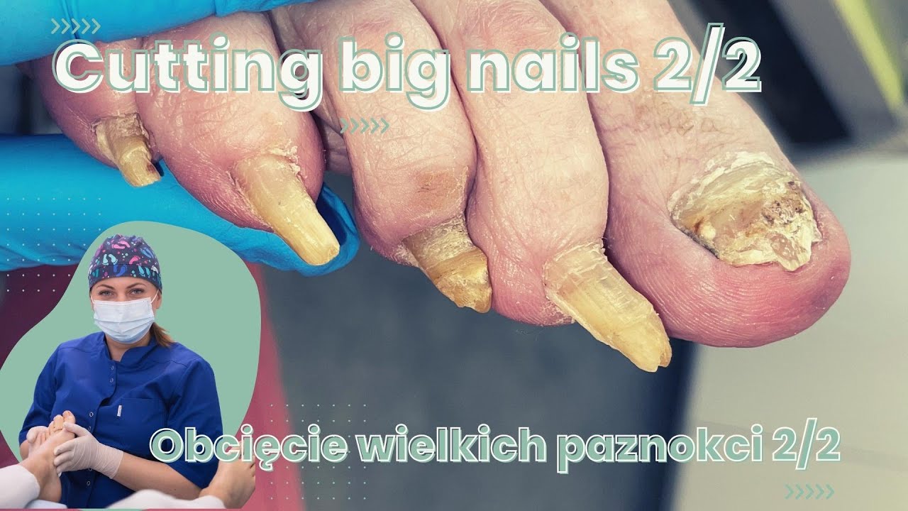 Cutting big nails 2/2 / Obcięcie wielkich paznokci 2/2 - YouTube