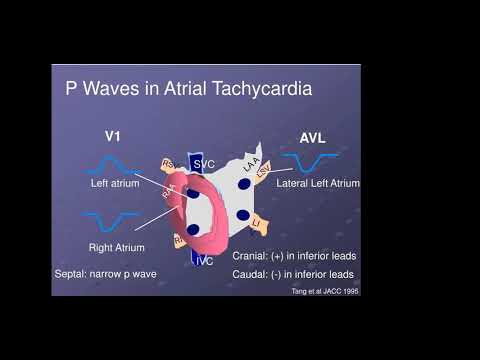 Atrial Tachycardia types and localization Dr Gehad Gamal - YouTube