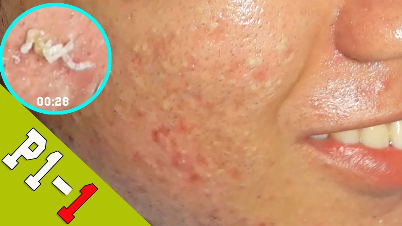 วิธีกำจัดสิวบนใบหน้า | Comedones Acne Extraction on Cheek (Client 1 ...