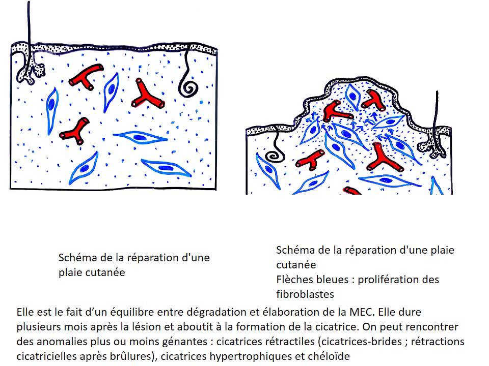 ANATOMI PATHOLOGIQUE REPARATION CICATRISATION - YouTube