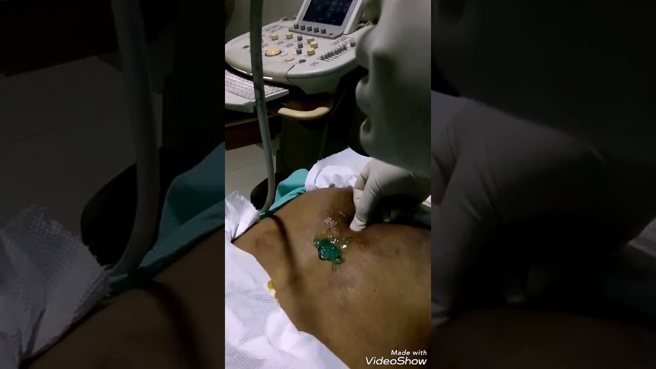 Title Ultrasound Guided Caudal Epidural Injection Technique By Dr