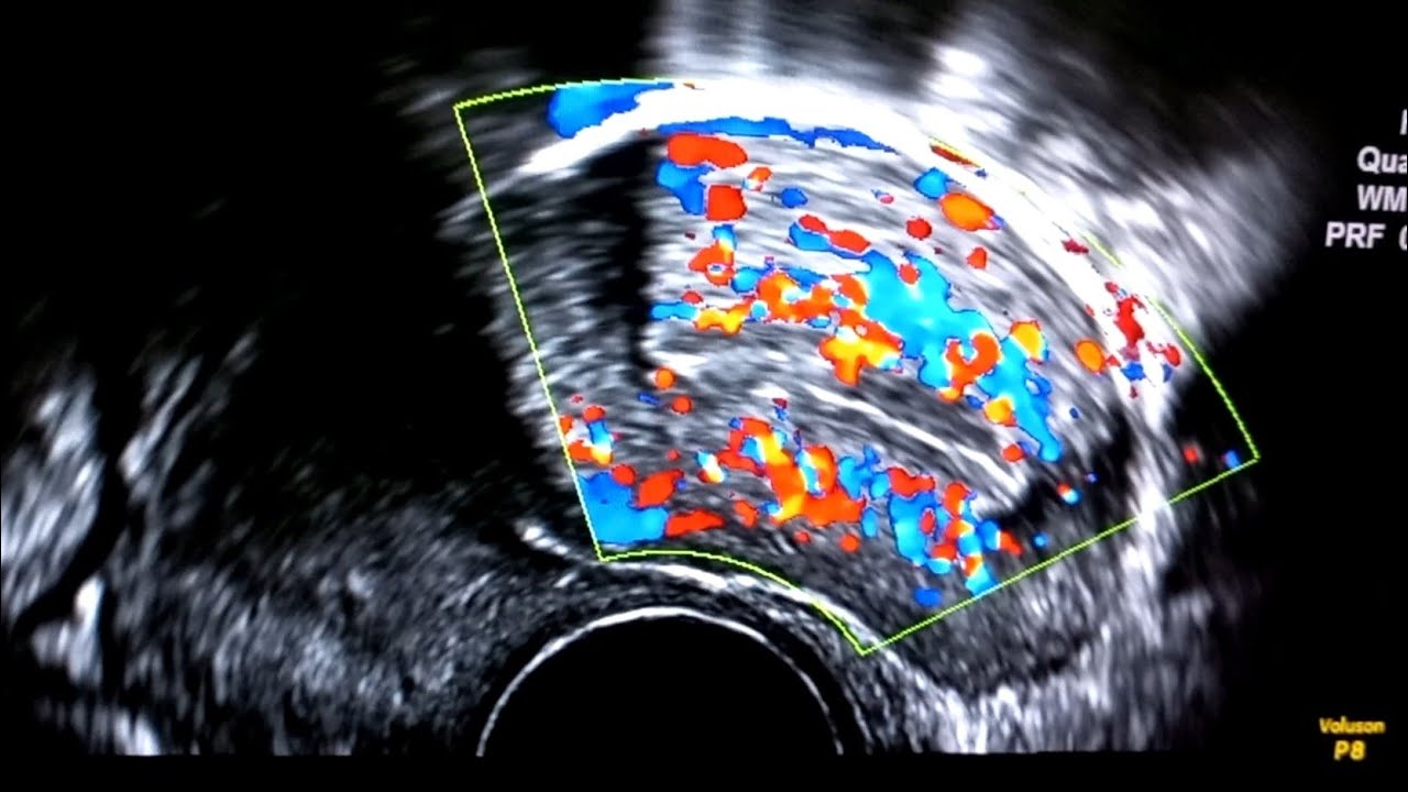 Follicle monitoring scan on day 9 of cycle - YouTube